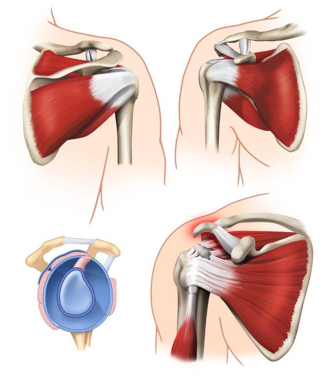 Pohledem fyzioterapeutky – ramena, co nesou tíhu světa - iVELO